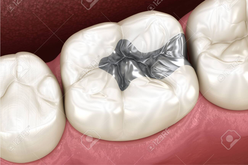 Fissure Sealants | Pulteney Dental Practice